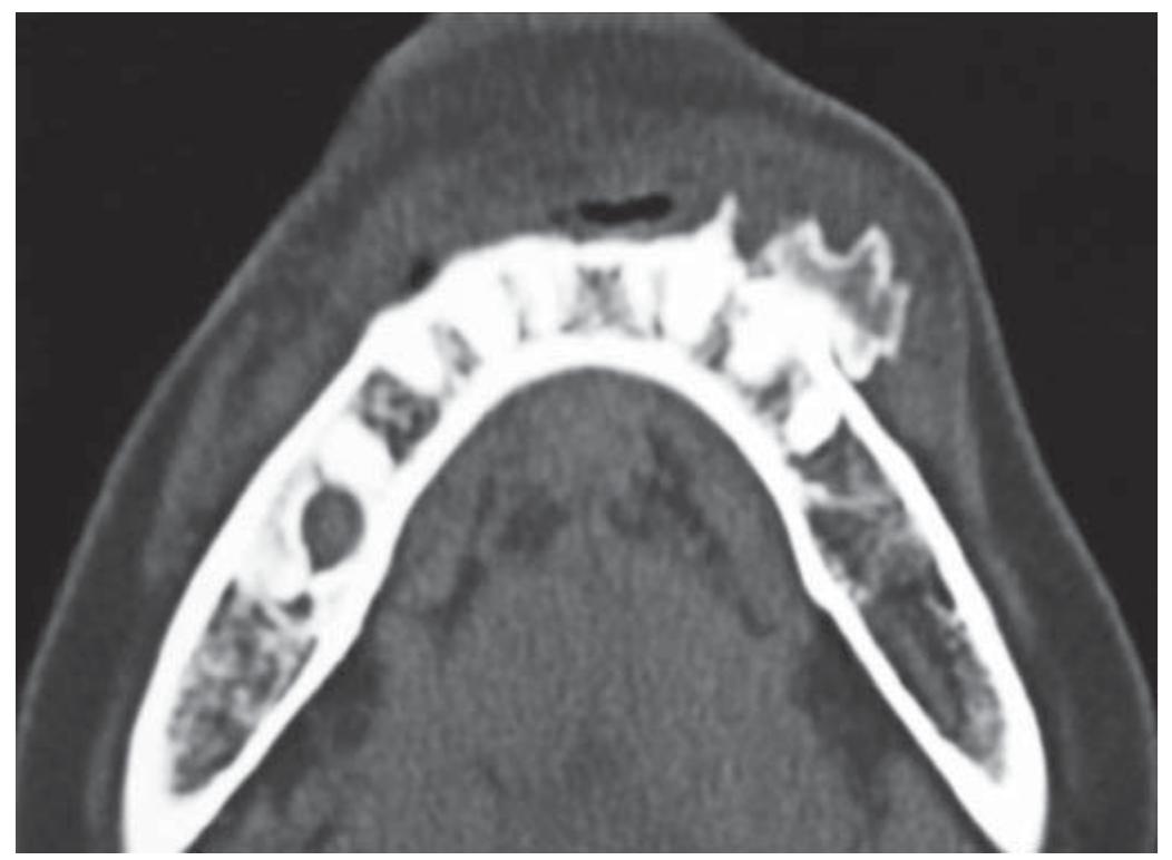 Exophytic bony lesion on left body of mandible in continuity