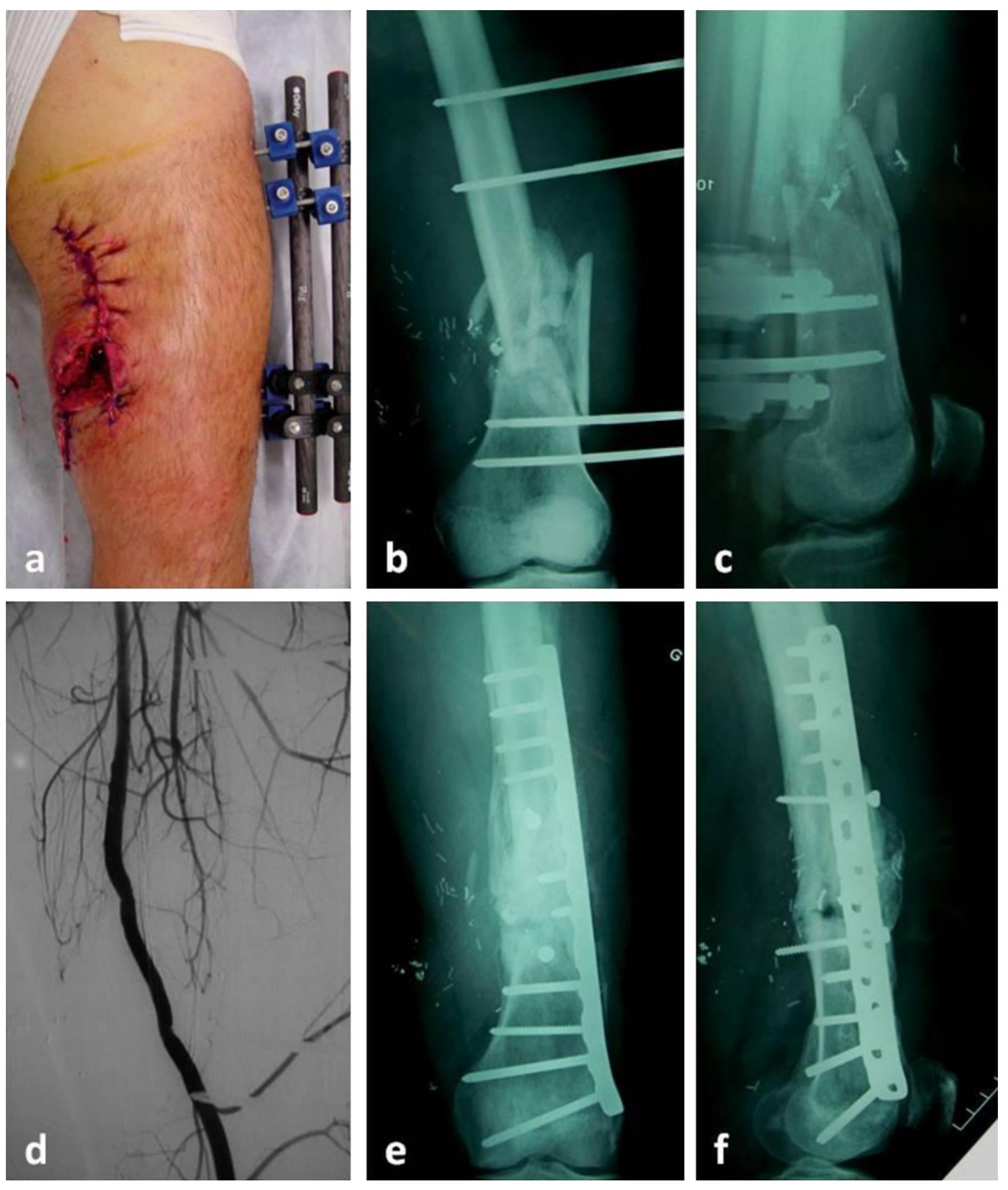 Open femoral fracture with laceration of the superficial