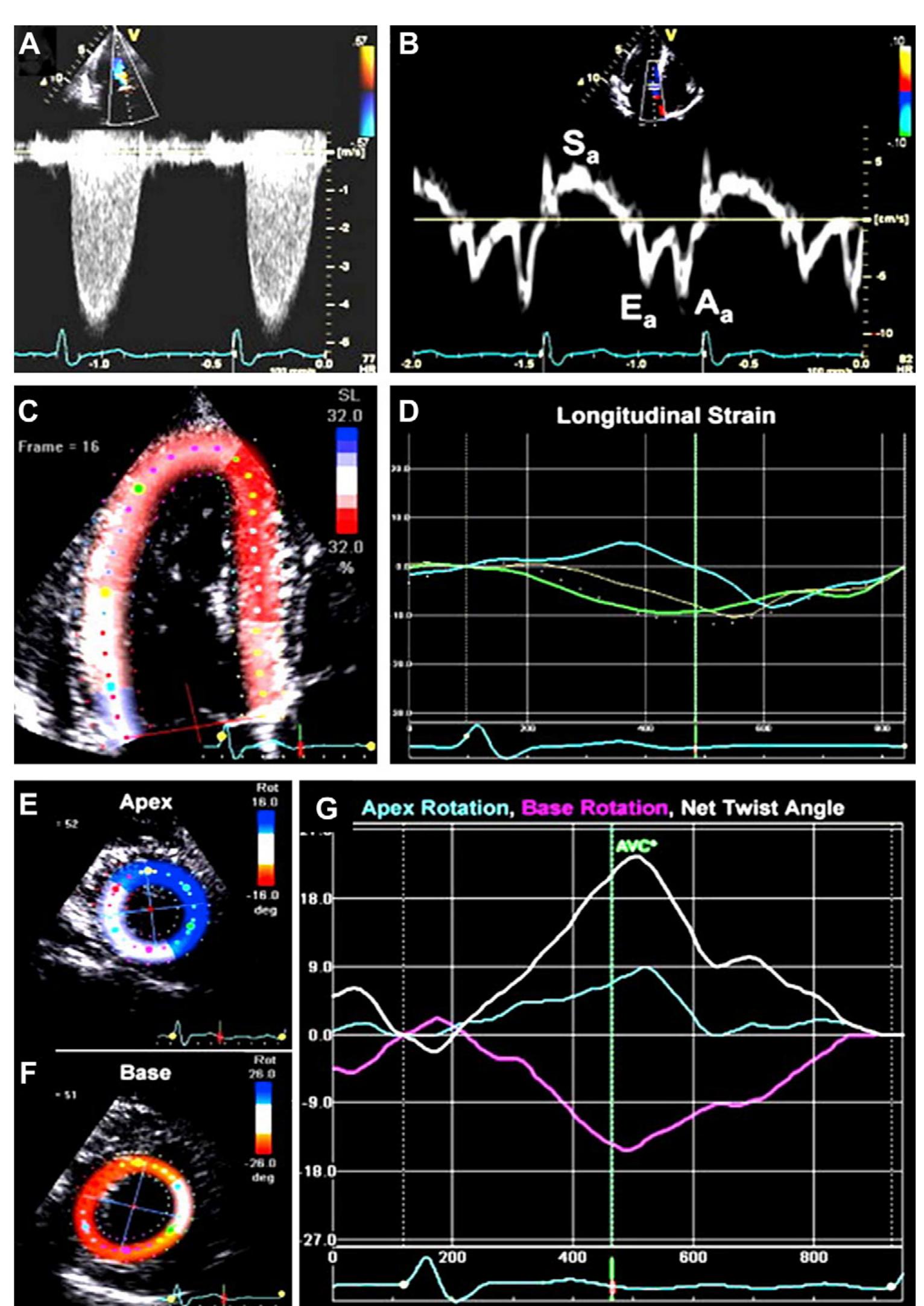 Lv mechanics in aortic stenosis. continuous-wave doppler