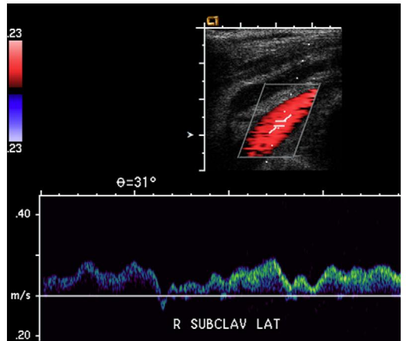 Normal subclavian vein. longitudinal color and spectral