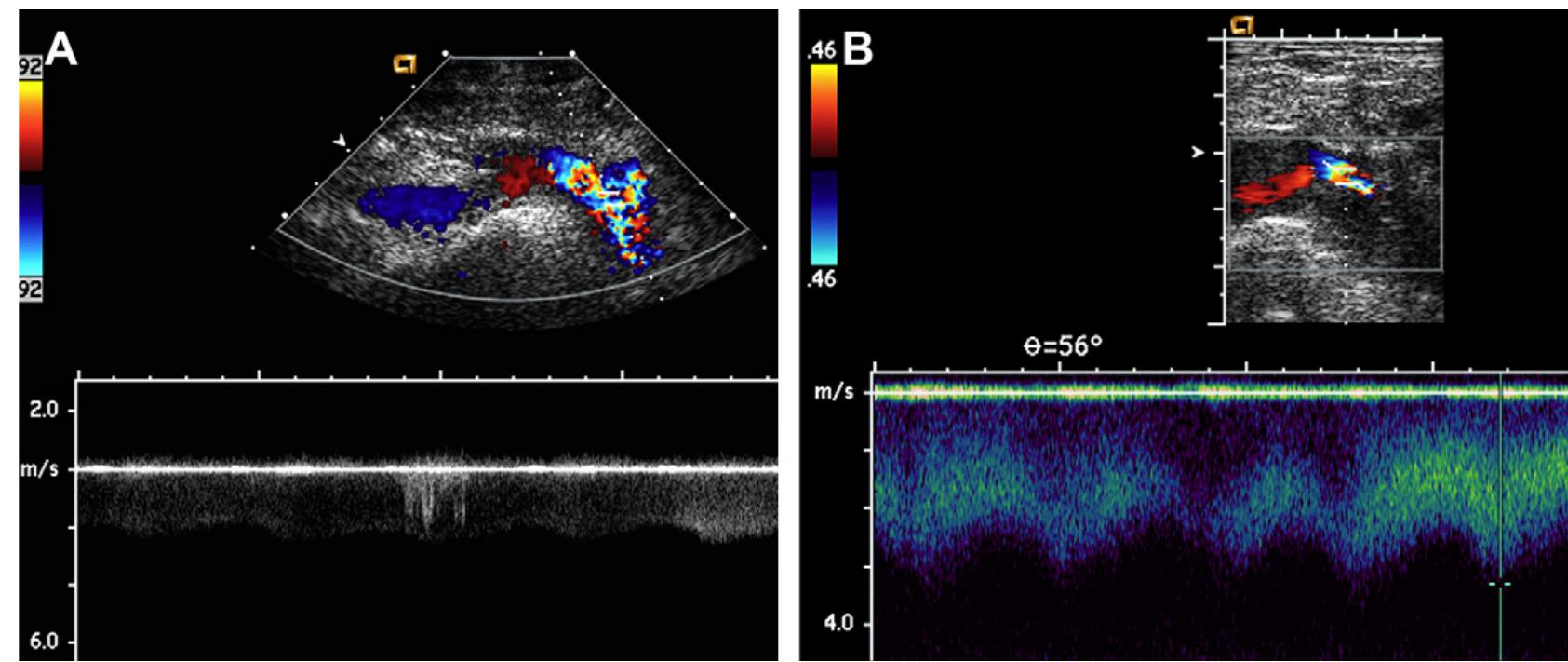 Central venous occlusion. (a) longitudinal doppler