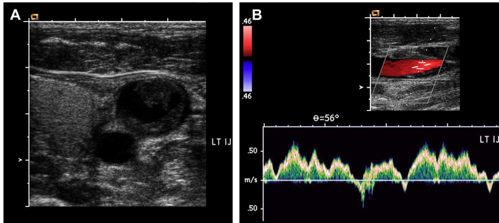 Nonocclusive deep venous thrombosis. (a) transverse