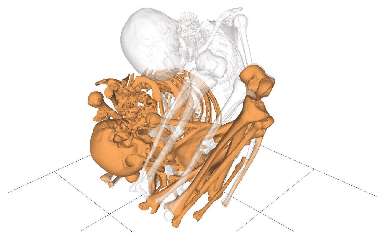 8 the bone displacement in a body donation placed in an