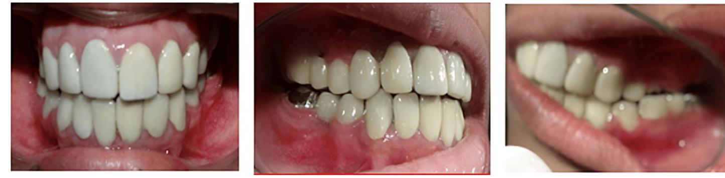 Frontal, right lateral, and left lateral view of intra-oral