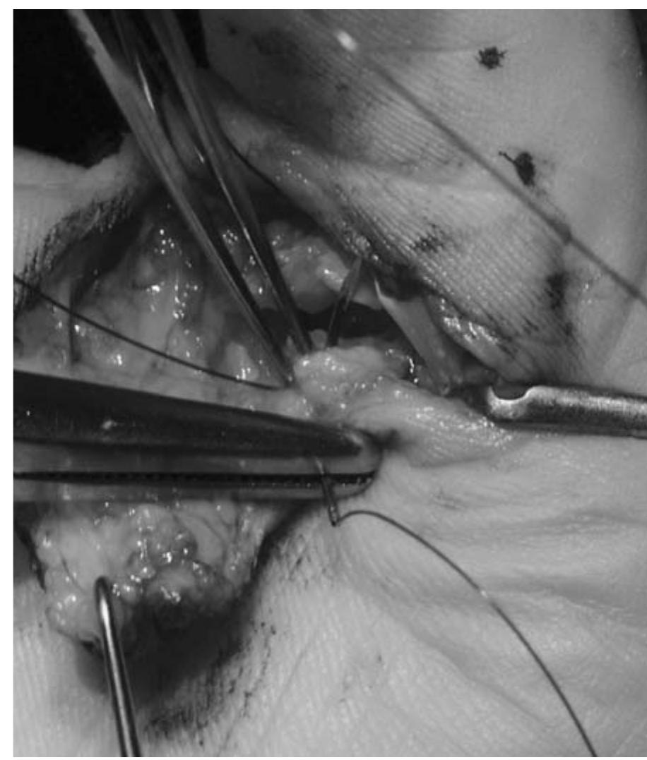 Suture placed in proximal volar plate. reattachment of both