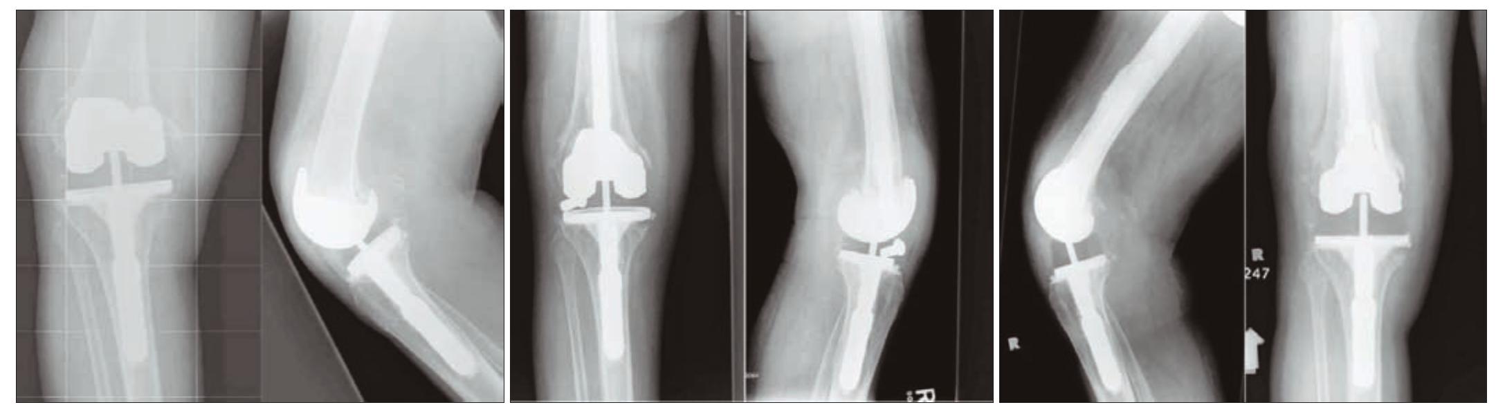 Ap and lateral. the femoral components were revised. the