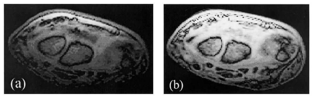 Images of wrist acquired using normal metal probe at room