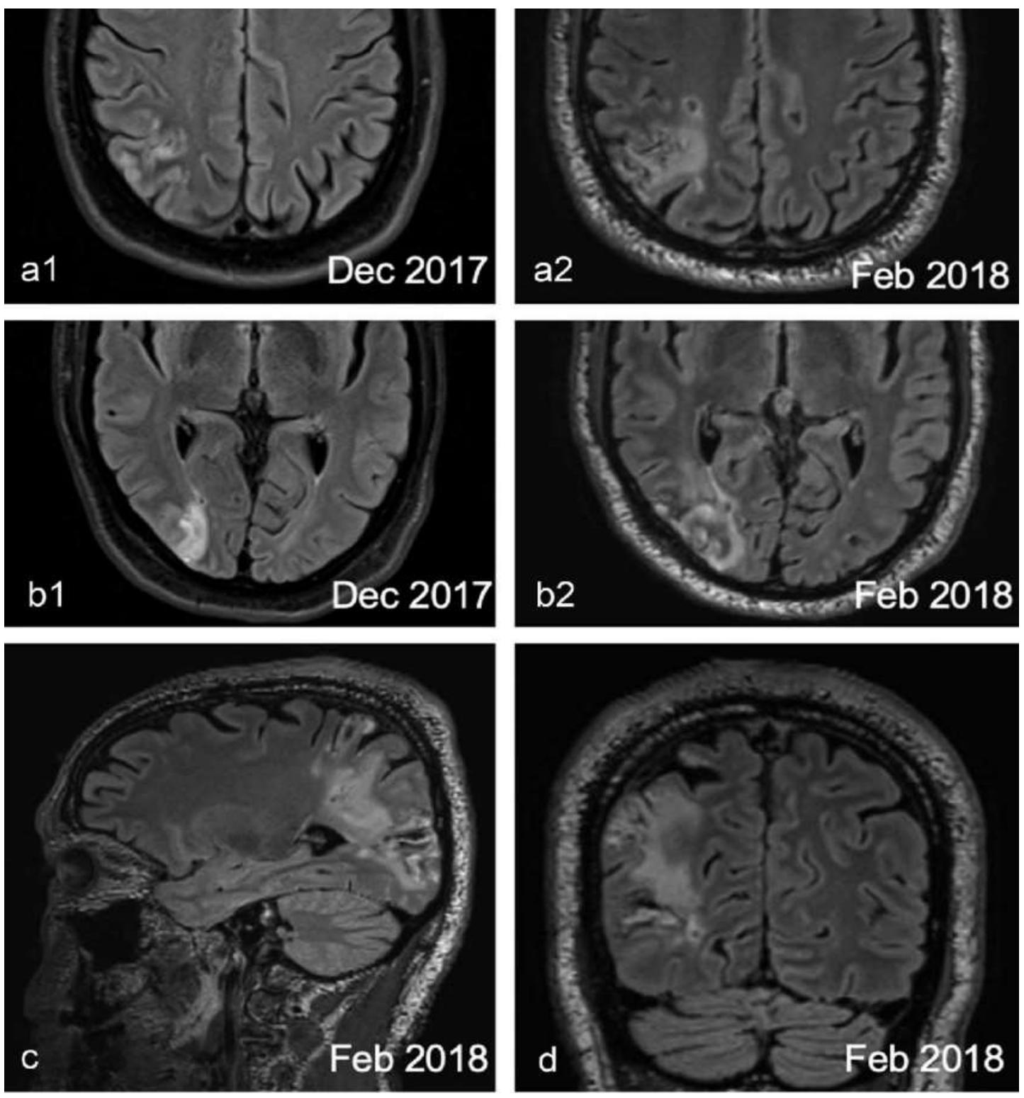 Flair mri images of dn’s brain (“a shrunken world