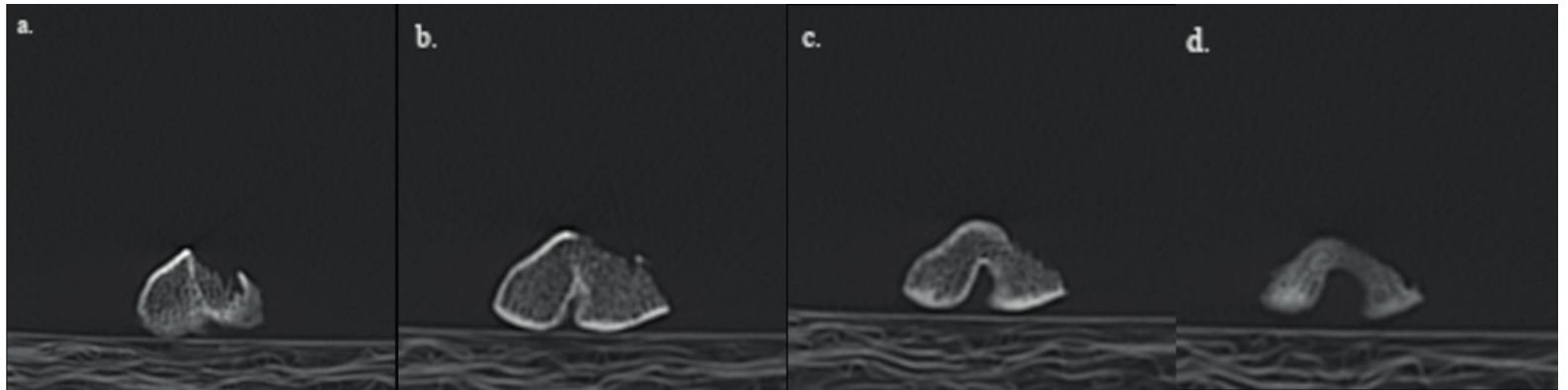 Series of ct scan images of bmc (a-d), displaying a series