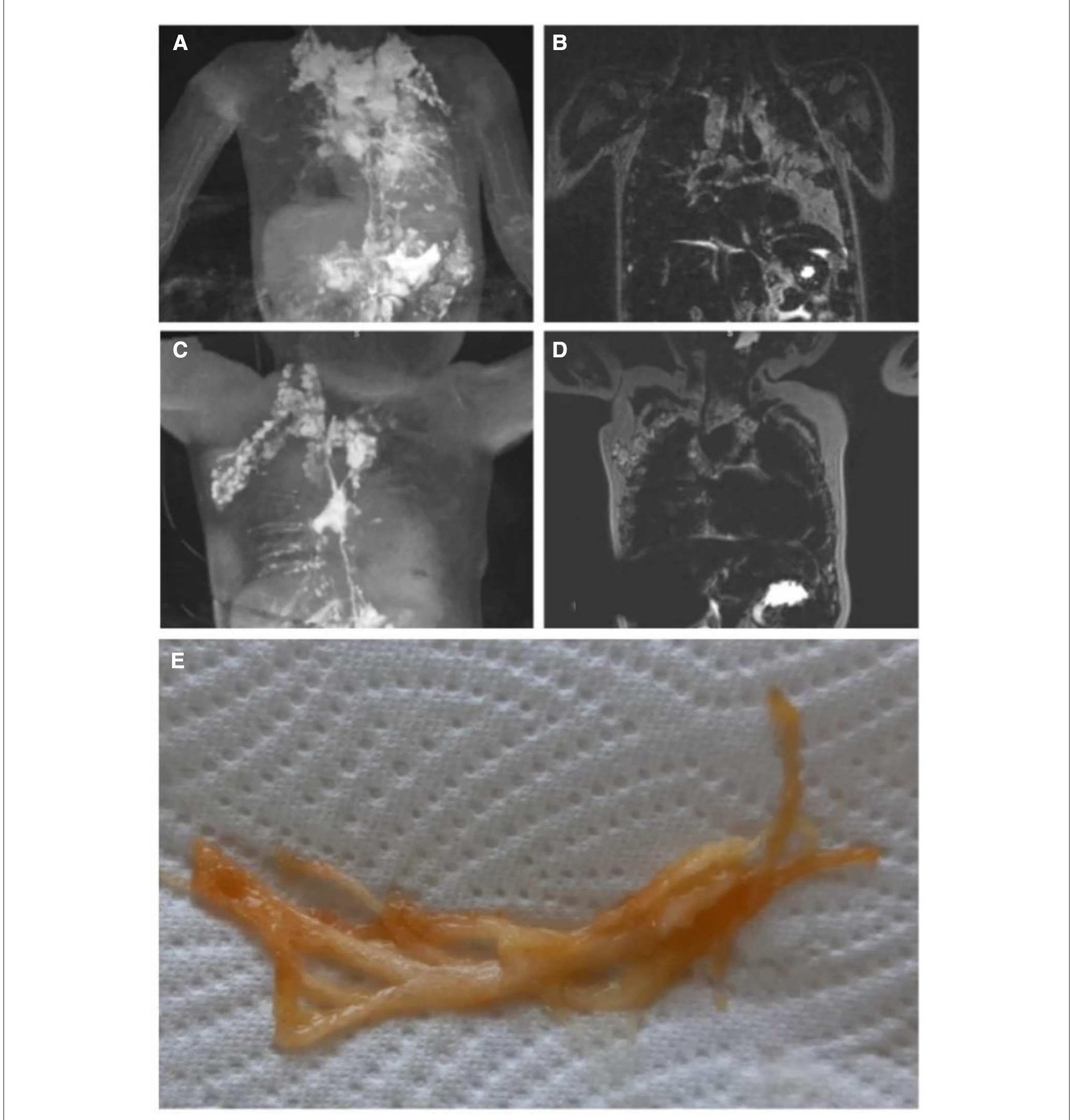 Pulmonary lymphatic perfusion syndrome. (a) coronal