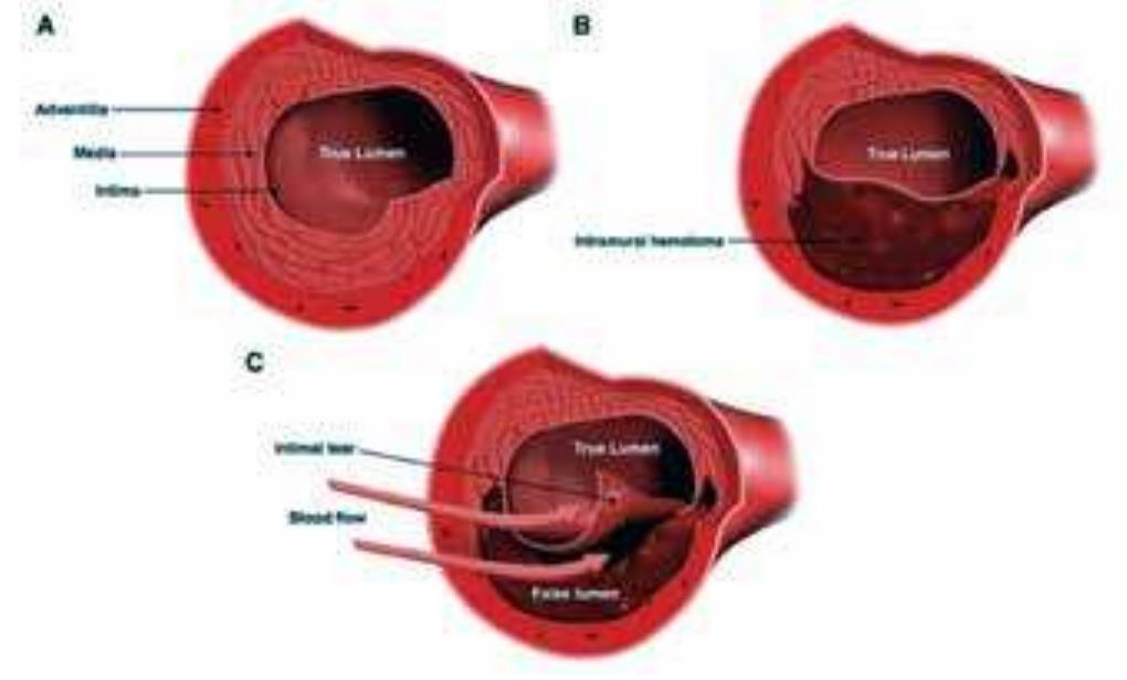 Cross-sectional views of the coronary artery. a, normal