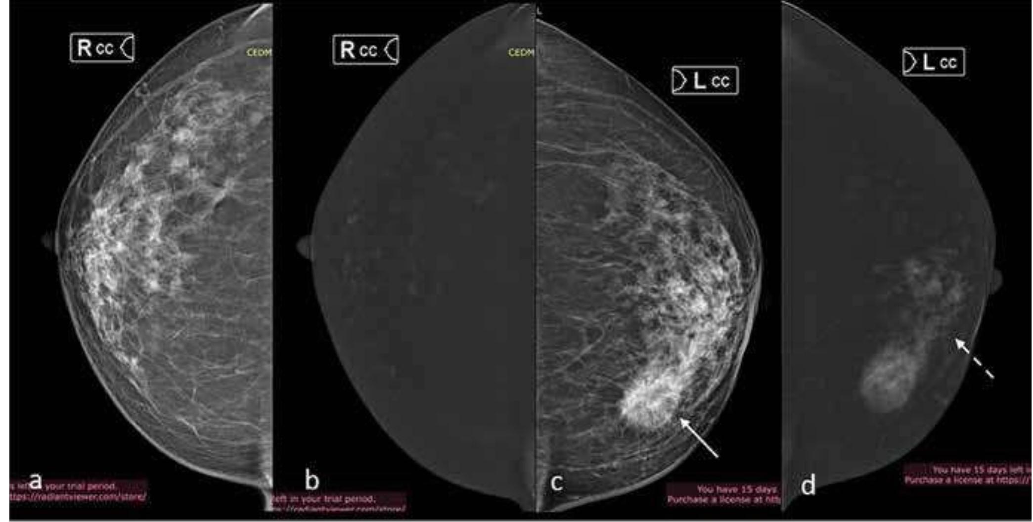Lump in left breast. low dose mammogram image of right