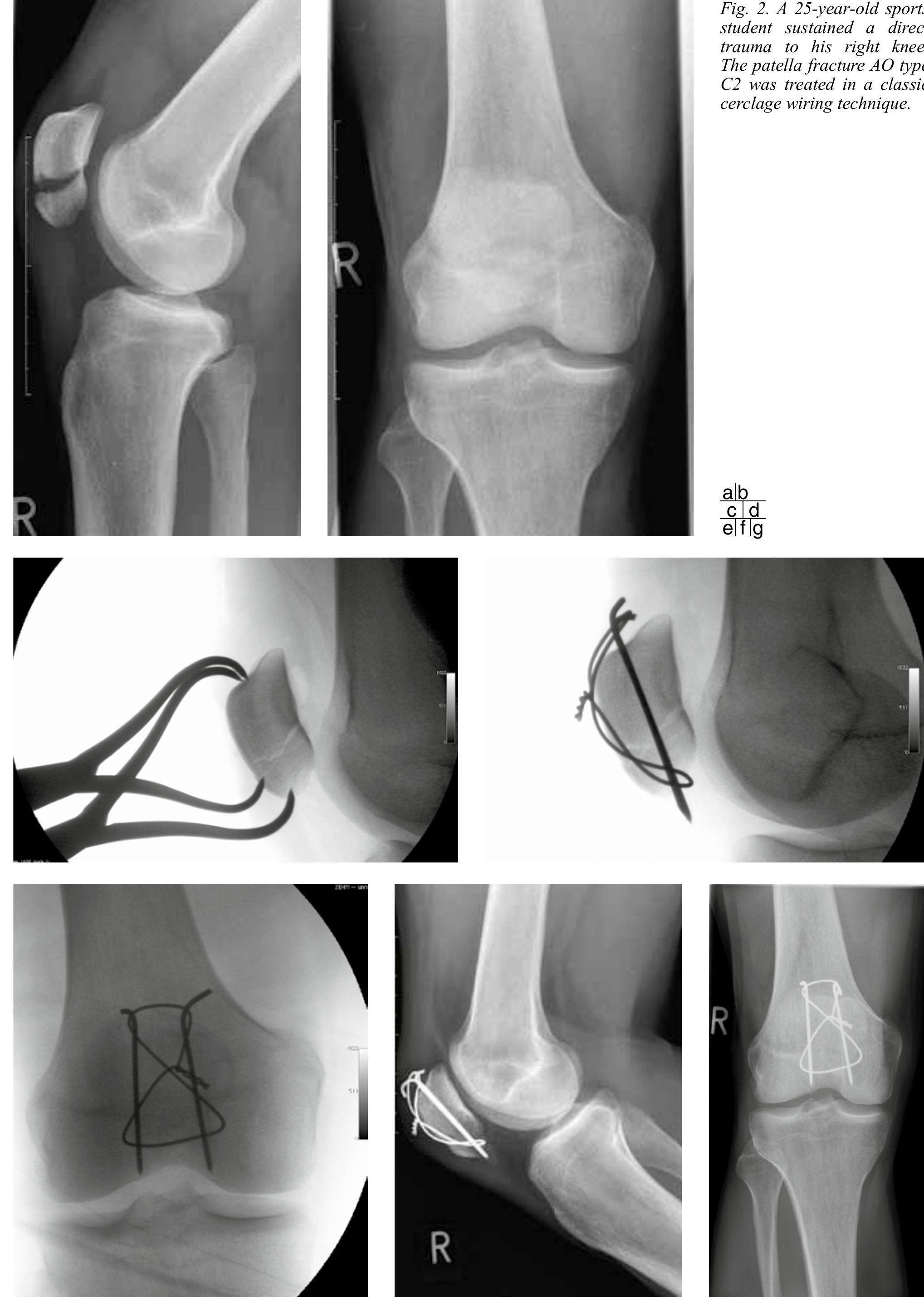 Figure 2 - Patellar Fractures - a Review of Classification,