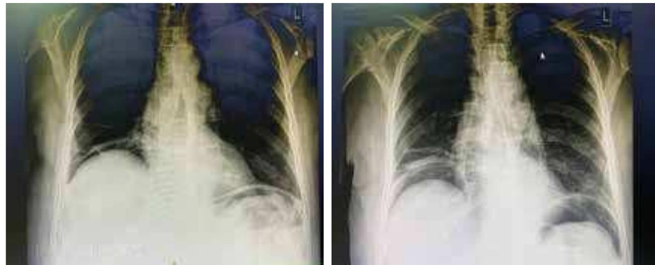X-ray of the chest: plate atelectasis of the basal parts of