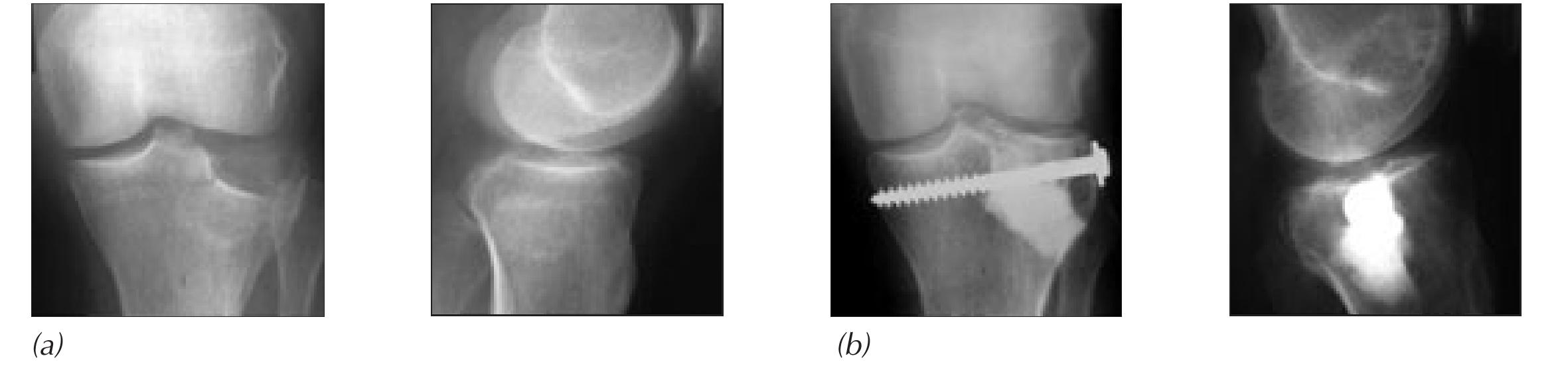 (a) ap and lateral radiographs, 67-year old female with