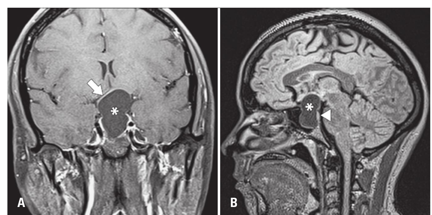 Pdf Sellar And Suprasellar Arachnoid Cyst
