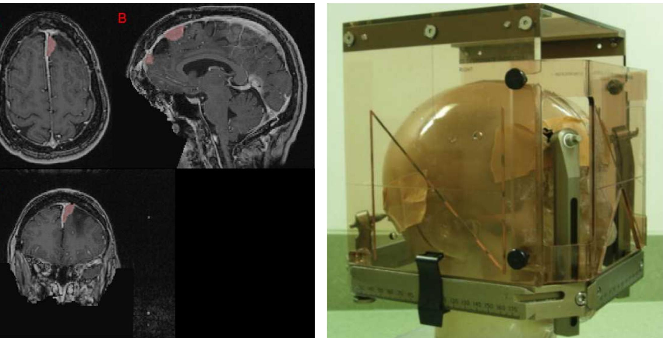 1: panels a, b, and c depict an anterior left falx
