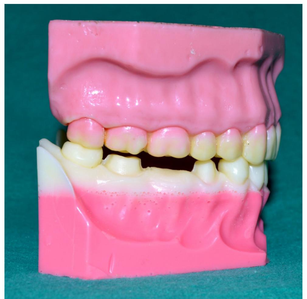 Epoxy resin models in maximum intercuspation.