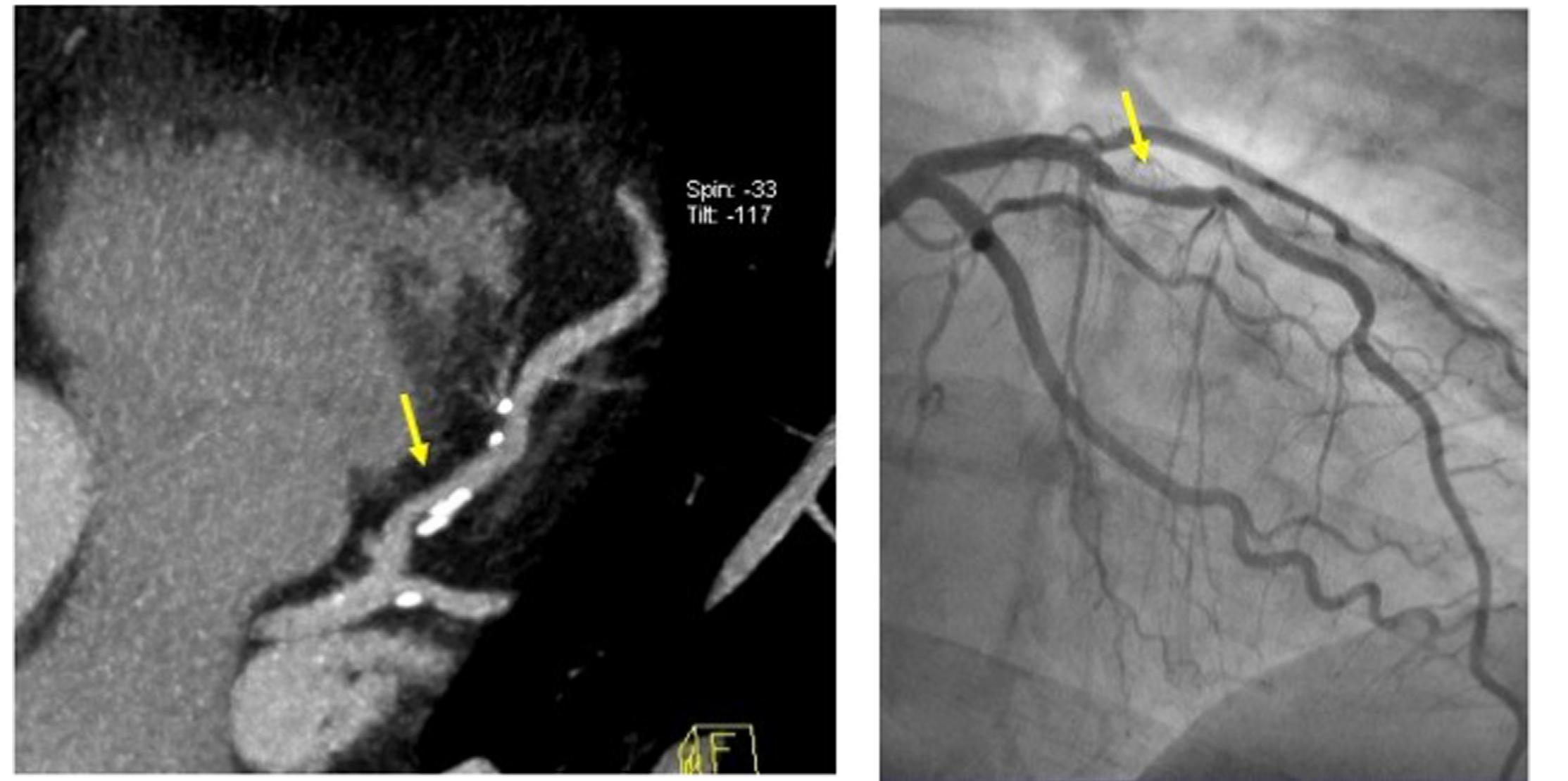 Cad-rads 2/p2 — mild coronary stenosis (25-49%). plaque