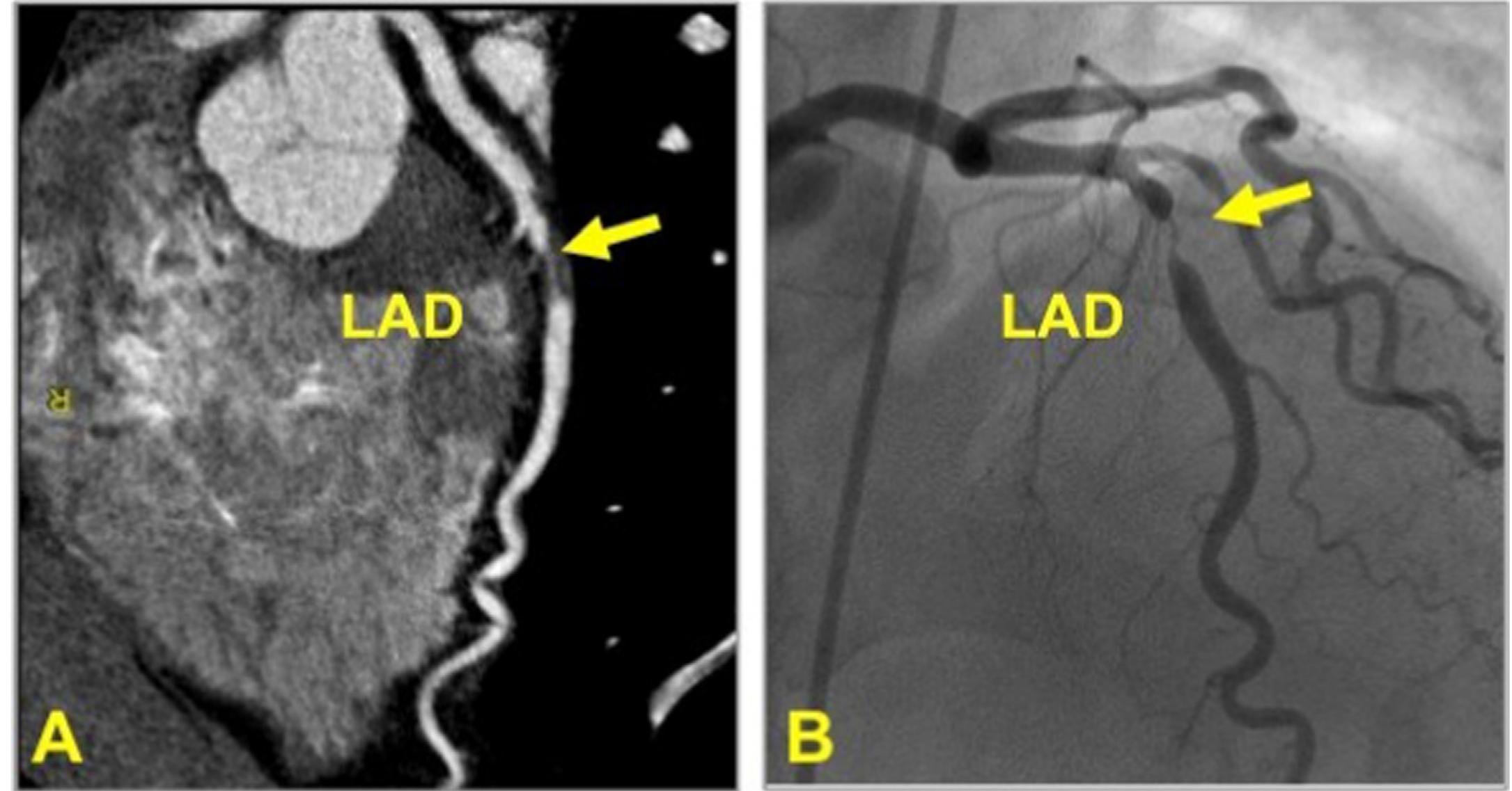 Cad-rads 4a/p1. focal non-calcified plaque in the mid lad