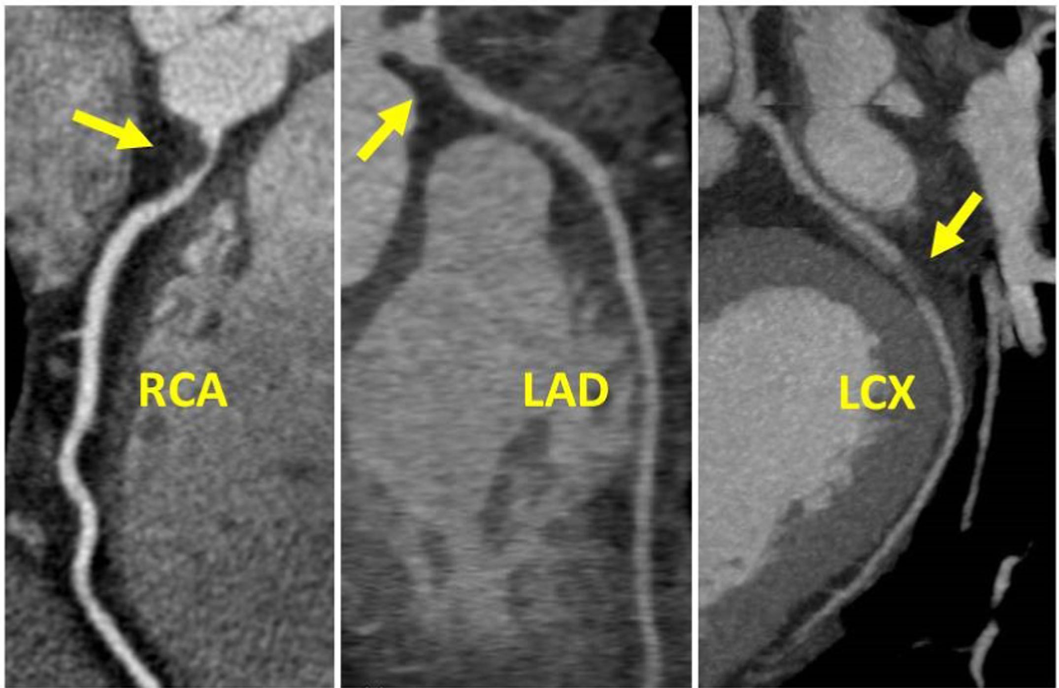 Cad-rads 4b/p2. three-vessel obstructive disease (>70%