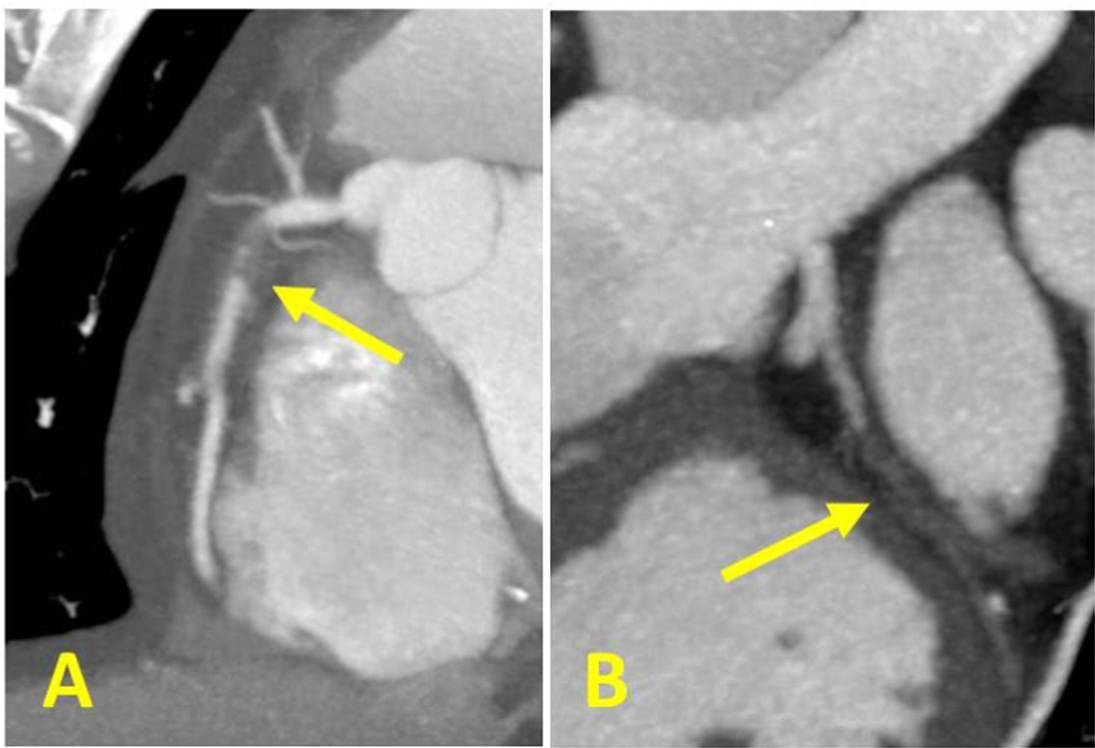 Cad-rads 5/p3. two examples of 5mm thick mips ccta cases