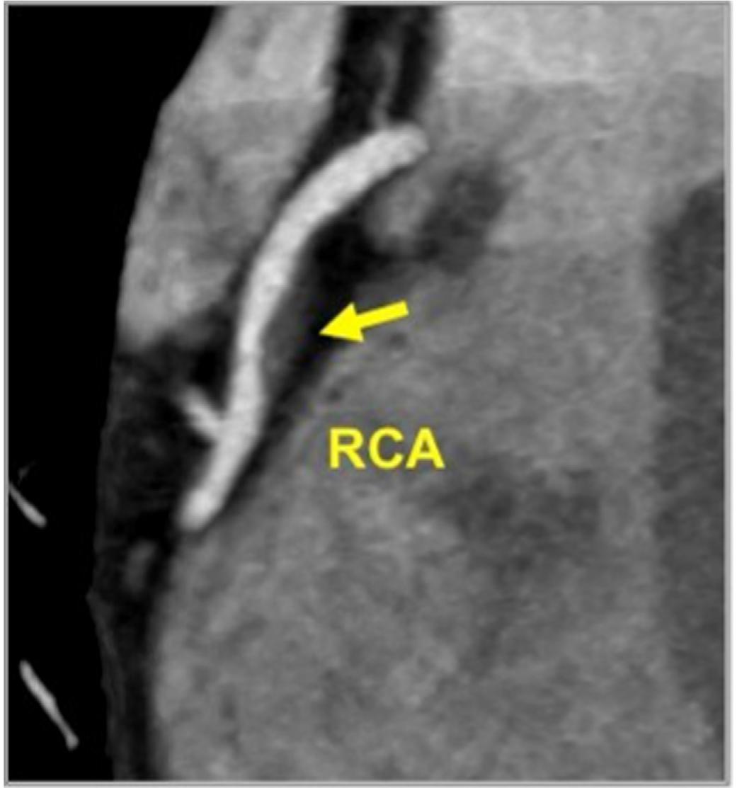 Figure 16 - CAD-RADS™ 2.0 – 2022 Coronary Artery Disease