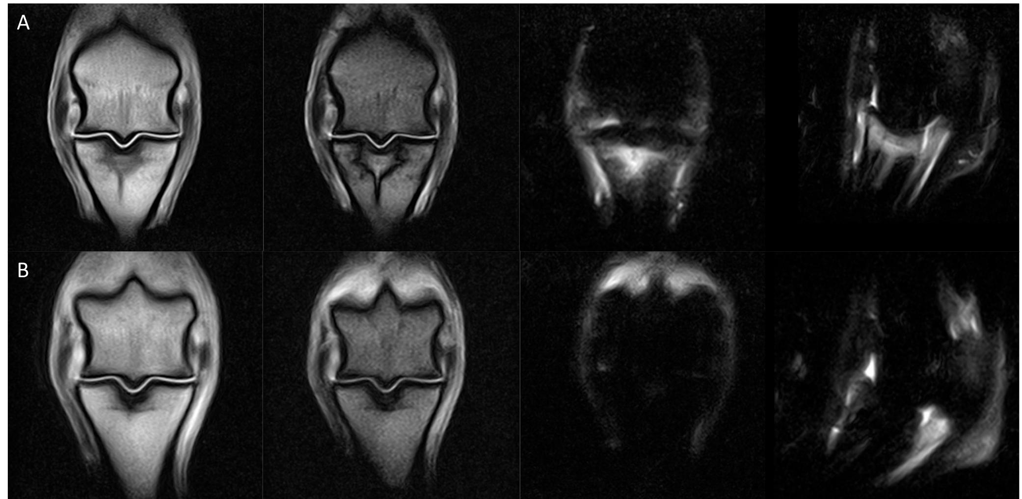 From left, dorsal tiw gre, dorsal t2 gre, dorsal stir and