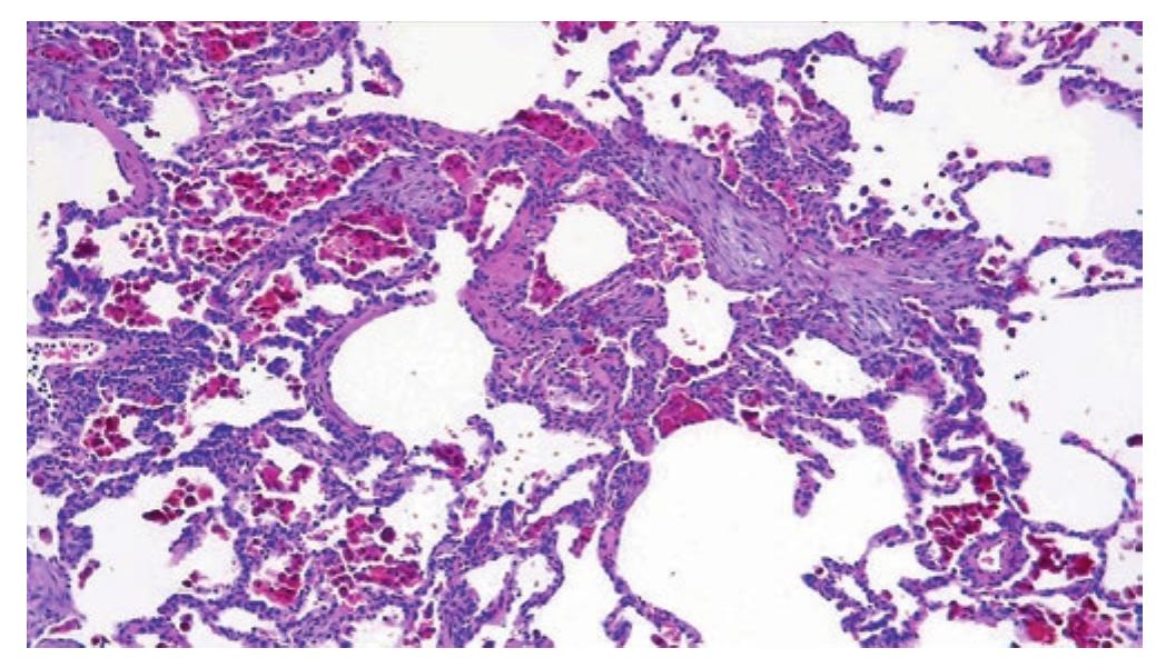 28 alveolar hemorrhage (capillaritis): there is a diffuse