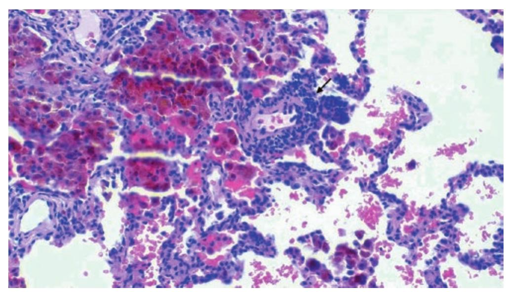 30 alveolar hemorrhage (capillaritis): the alveolar hemosid-