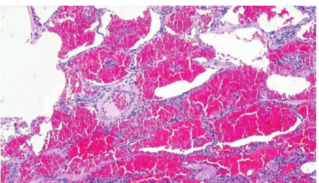 39 artifactual intra-alveolar hemorrhage. the diffuse