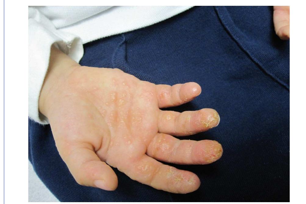 (PDF) Dyshidrotic Eczema