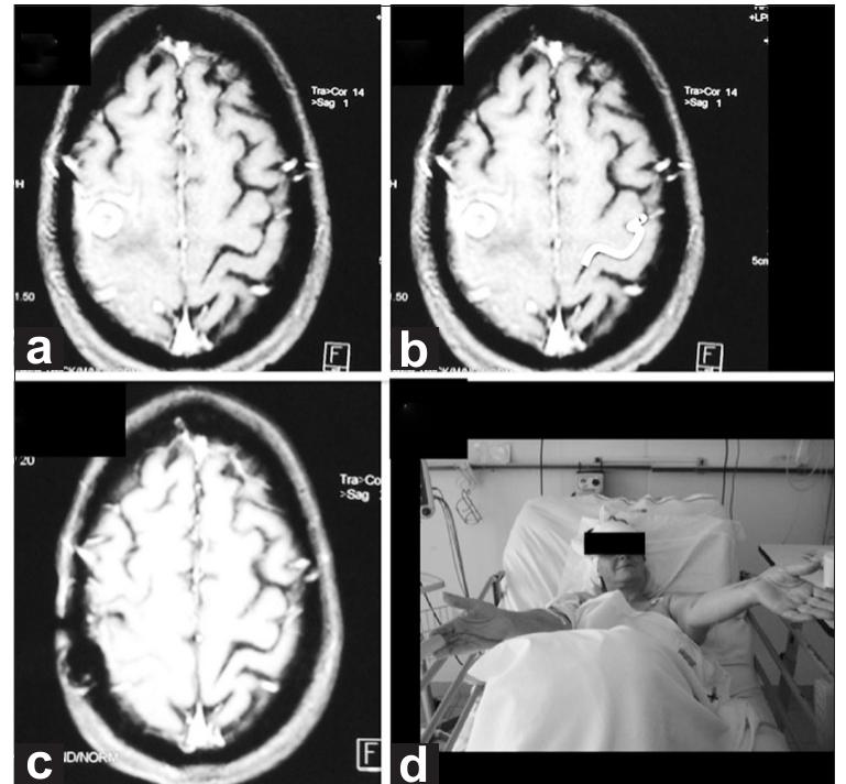 (a and b) pre-op axial mri. imaging reveals a lesion in the