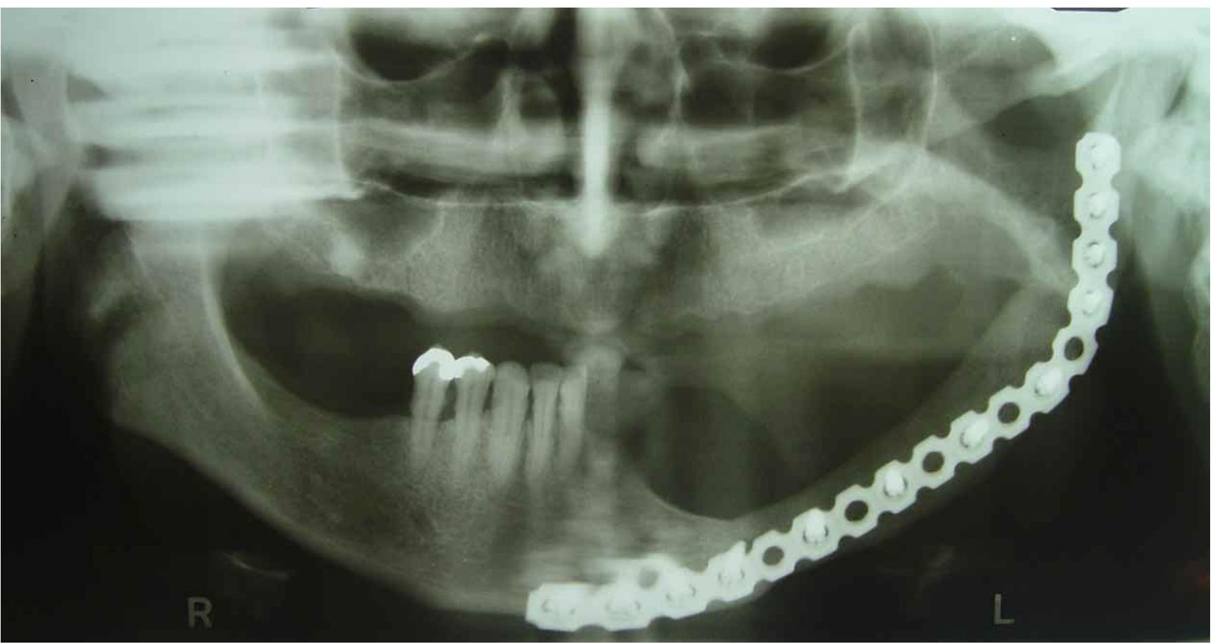 Six-month follow-up panoramic radiograph of the resection