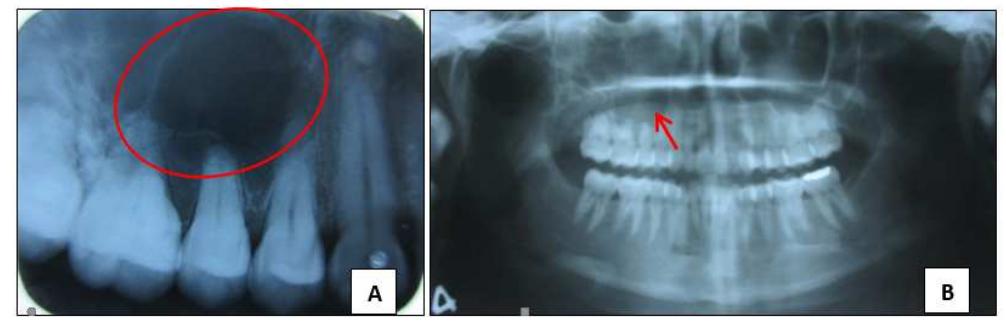 Radiographic presentation. (a) periapical radiograph