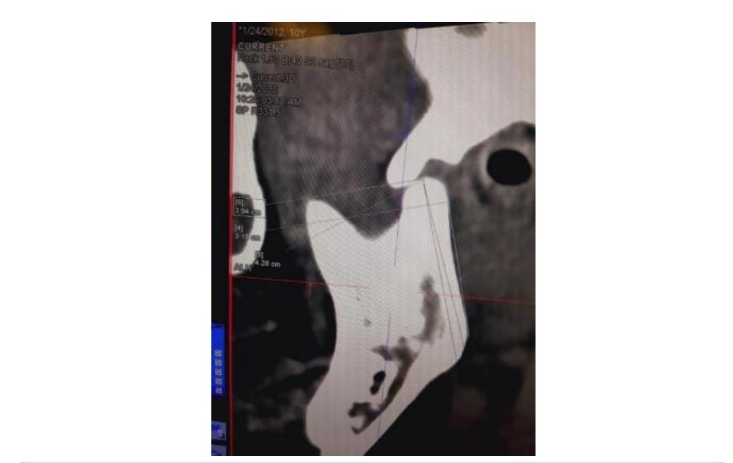 Measurement of length of ramus of mandible. figure 3: vrt