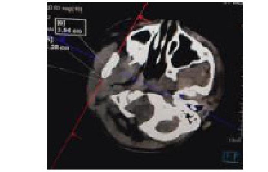 At the posterior border of the ramus between the most