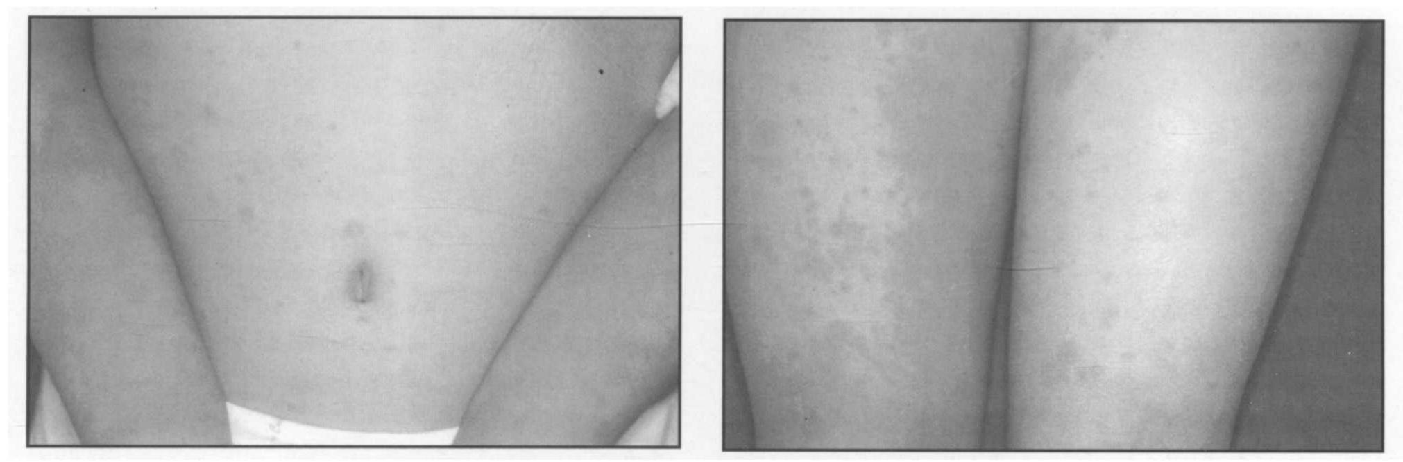 Skin rashes induced by antiepileptic drugs show different