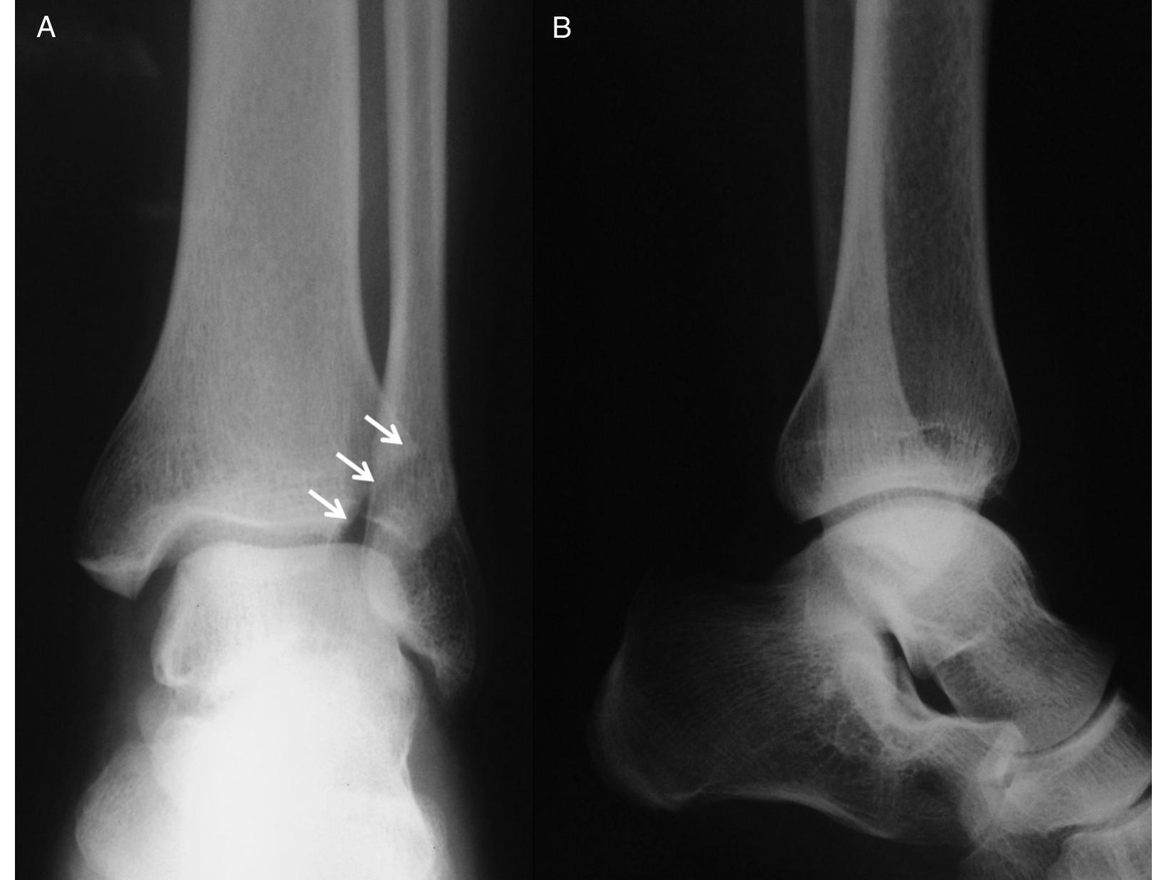 Anteroposterior (a) and lateral (b) ankle radiographs of the
