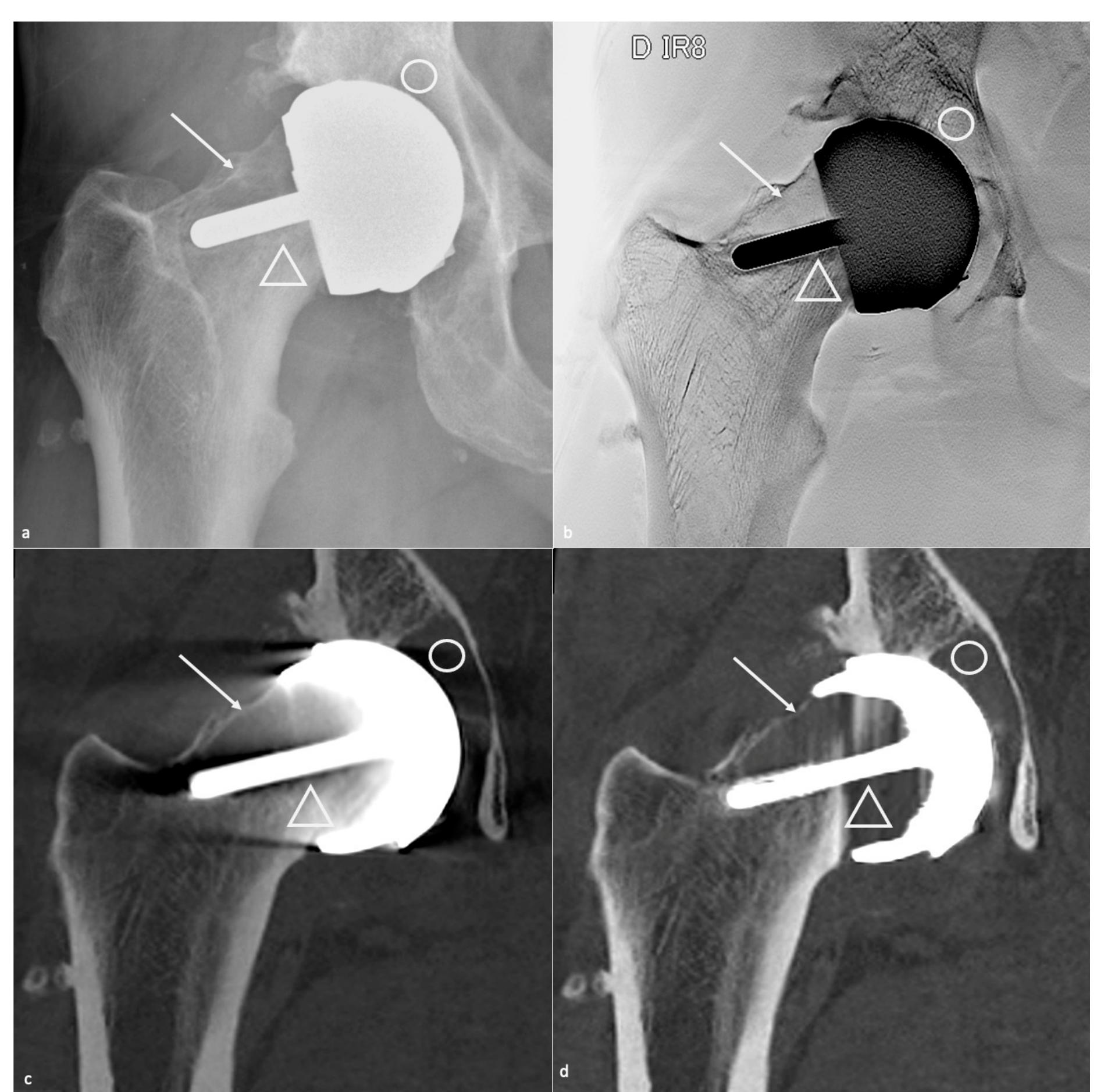 Peri-prosthetic osteolysis. radiolucent zones are shown on