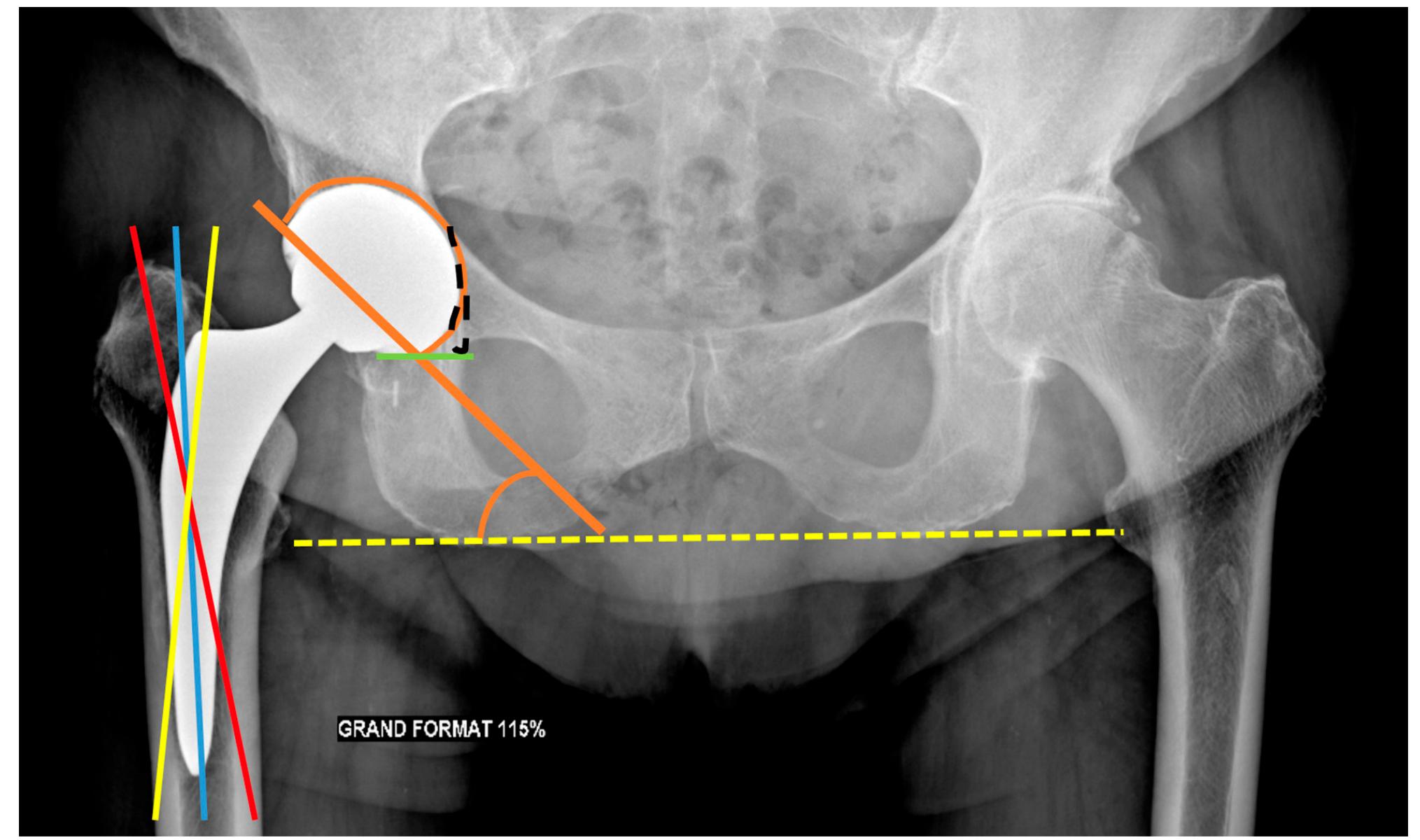 Acetabular frontal inclination and femoral stem position.