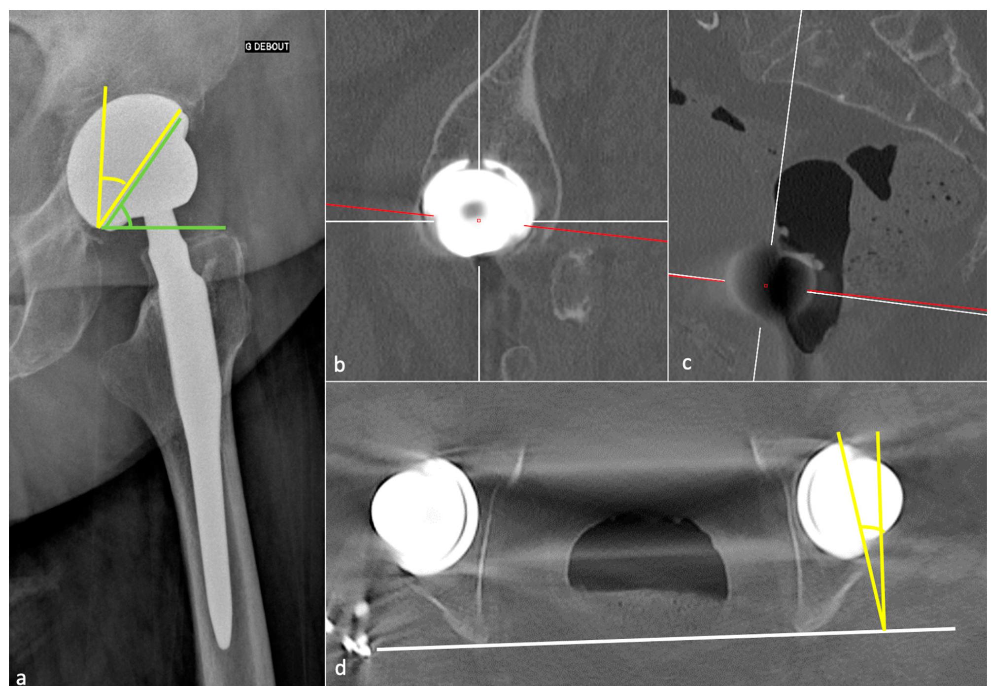 Acetabular cup anteversion and sagittal inclination. the