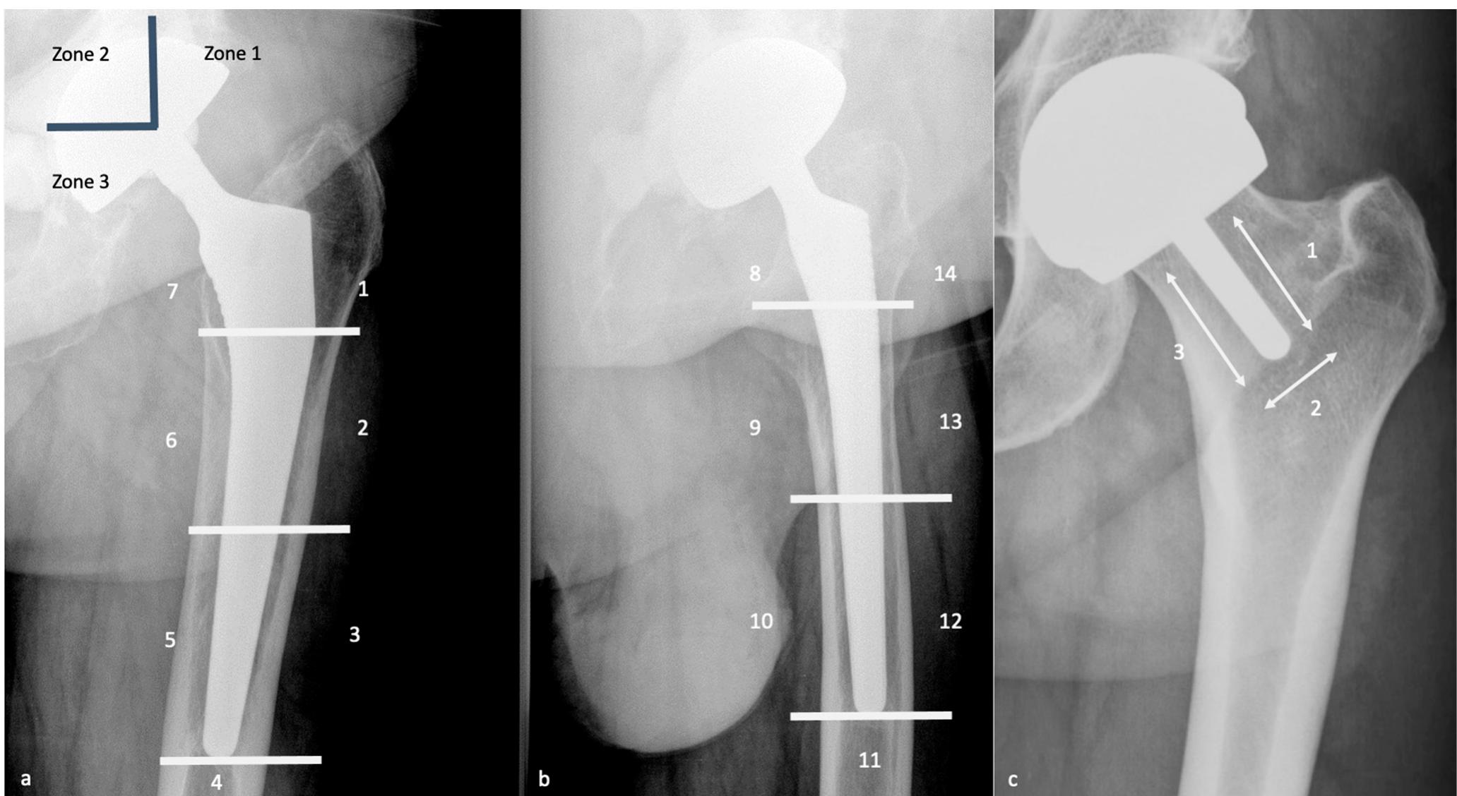 Acetabular and femoral zones to be described for osteolysis.