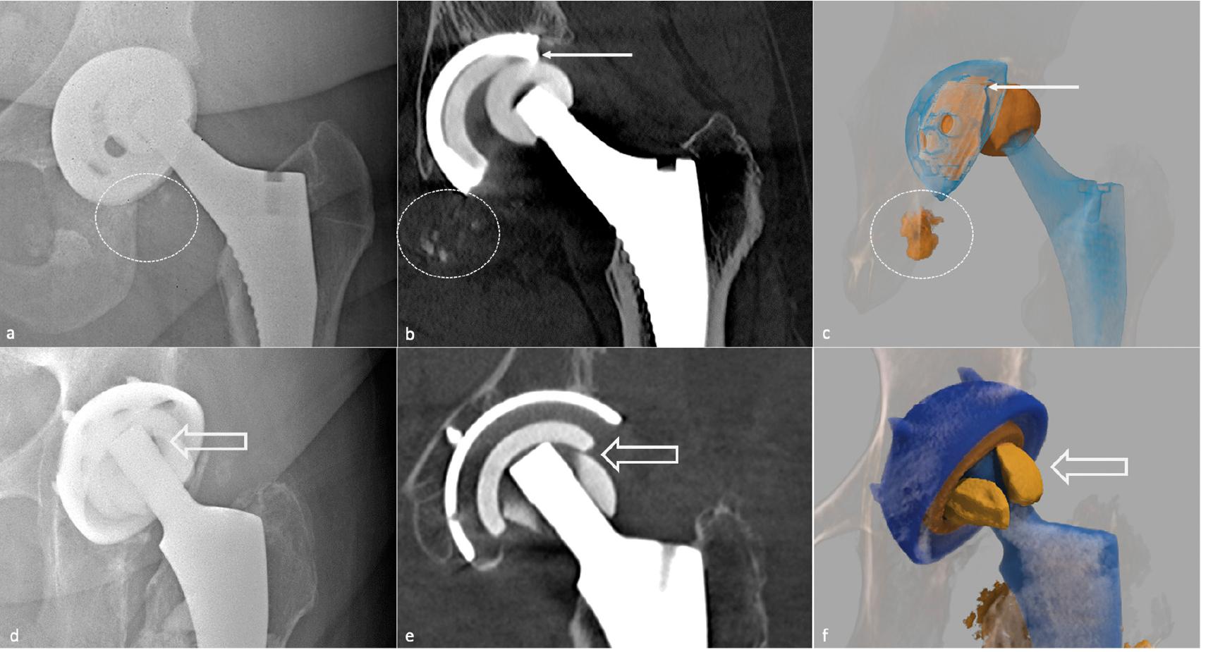 Figure 22 - from Imaging in Hip Arthroplasty Management Part