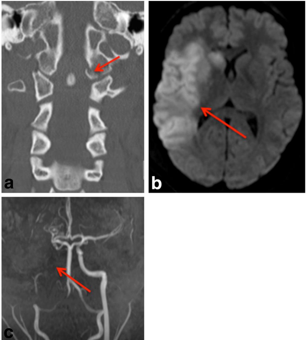 (a) coronal ct (bone windows) shows left occipital condyle