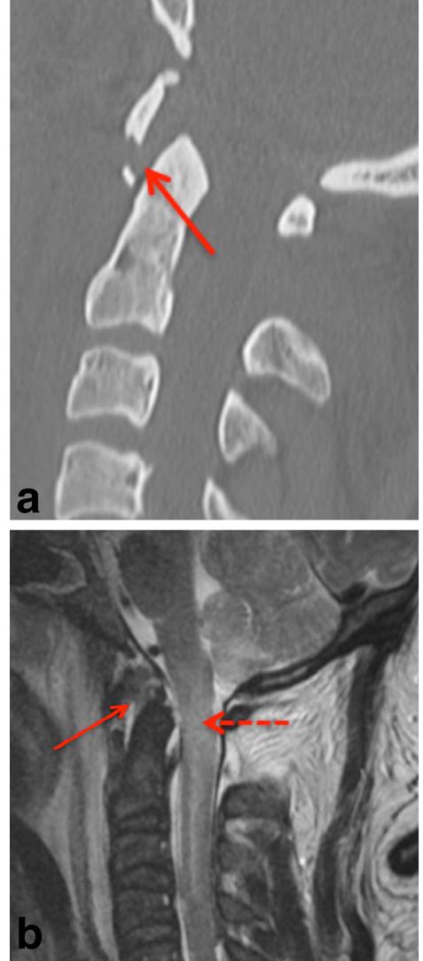 (a) sagittal ct (bone windows) shows avulsion fracture of