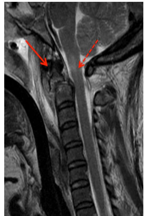 Sagittal t2-weighted mri shows complex dens fracture and