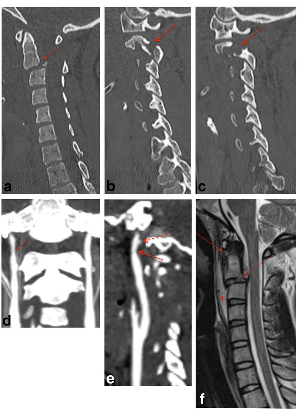 (a—c) sagittal and parasagittal views of an effendi type 2