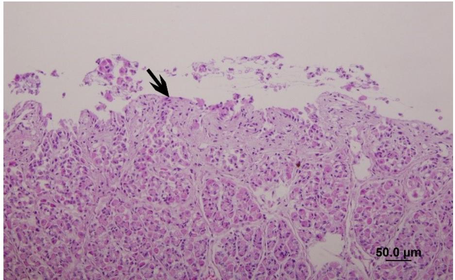 Atrophy and fibrosis in gastric mucosa (arrow) 200x, he