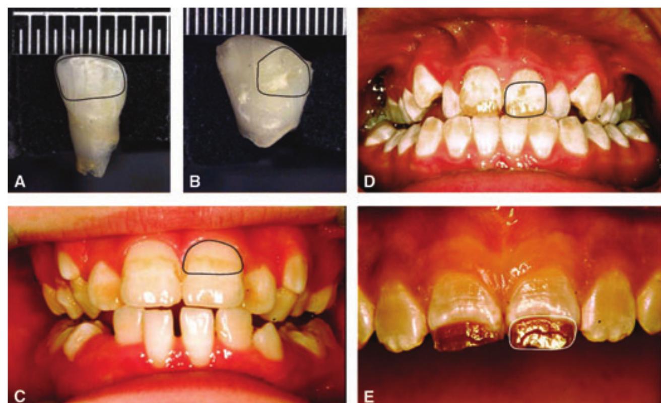 Example of enamel defects index (edi) scoring on images